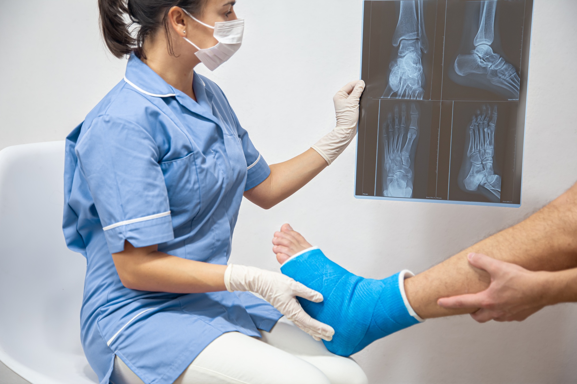 Fractures du Pied : Comprendre les Blessures Sportives